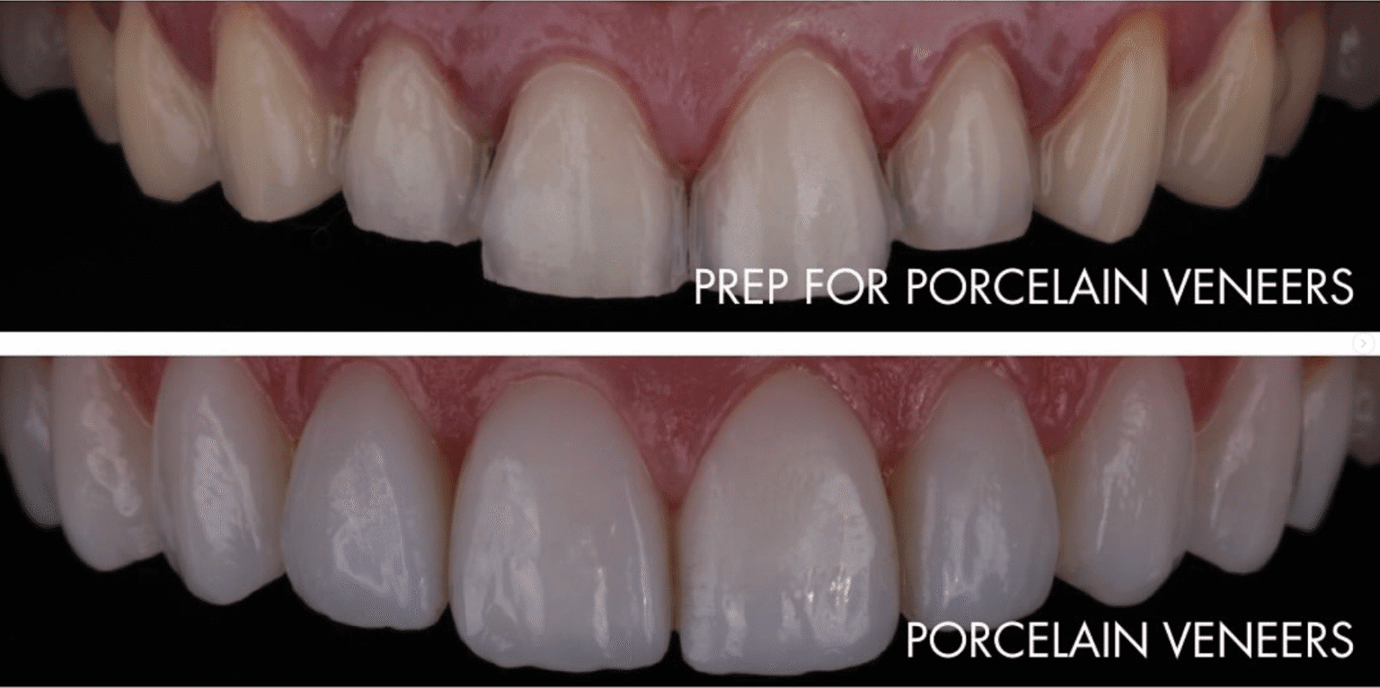 What Does Teeth Look Like Under Veneers: Why The Before And After ...