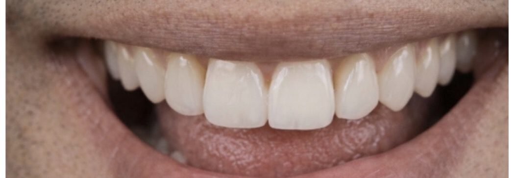Natural Smile Mock-Up Method by BBV - BeautyBeyondVeneers